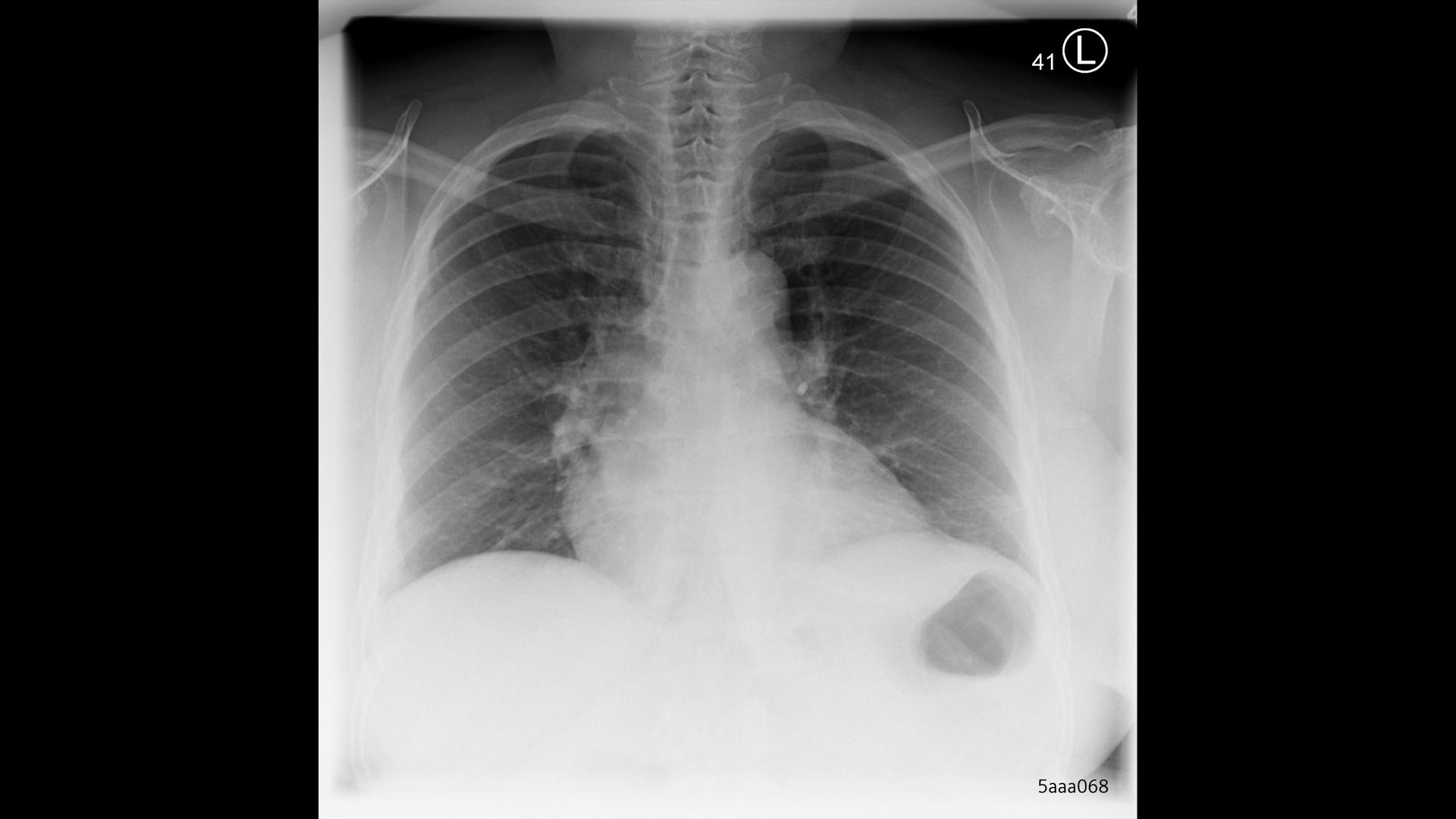 X ray Imaging For COVID 19 Patients X ray Imaging For COVID 19 Patients