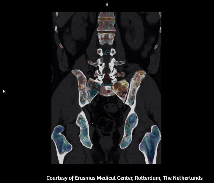 Photon-counting CT: quick and noninvasive scanning
