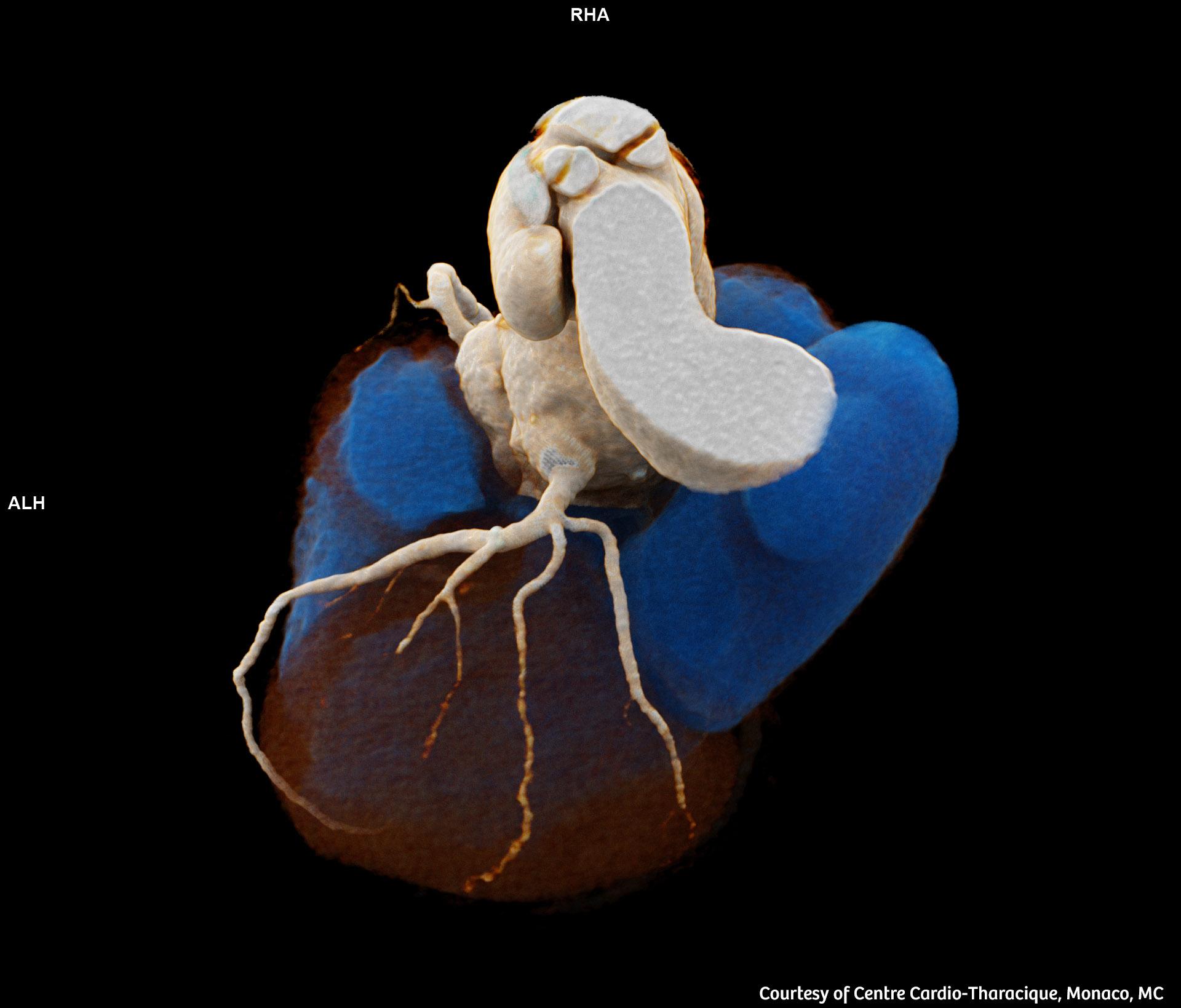 Photon-counting CT: quick and noninvasive scanning