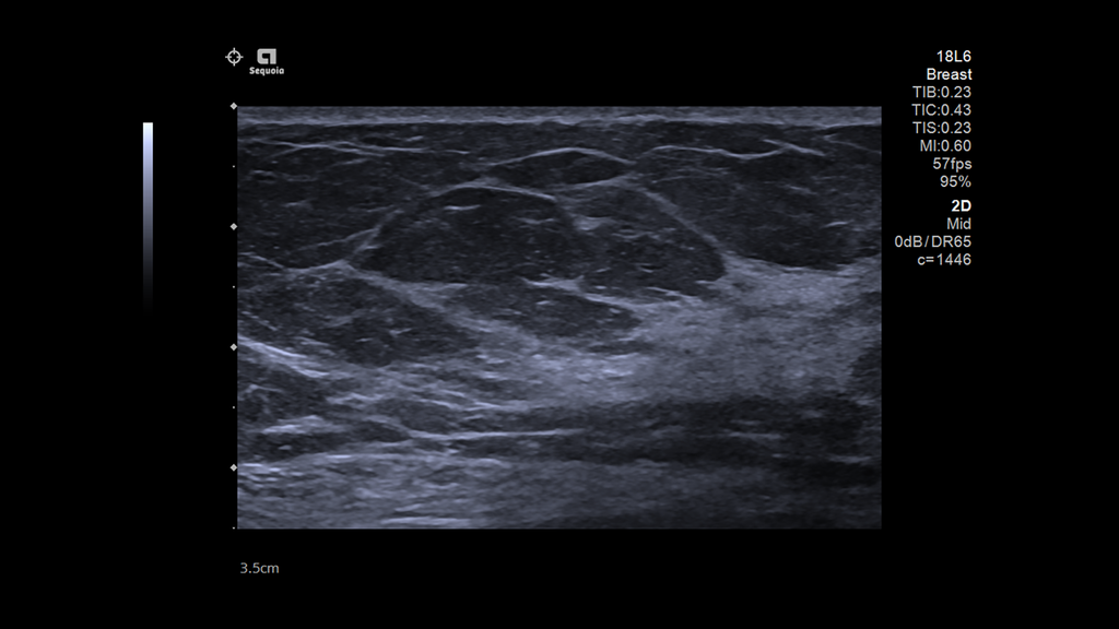 ACUSON Sequoia Ultrasound System