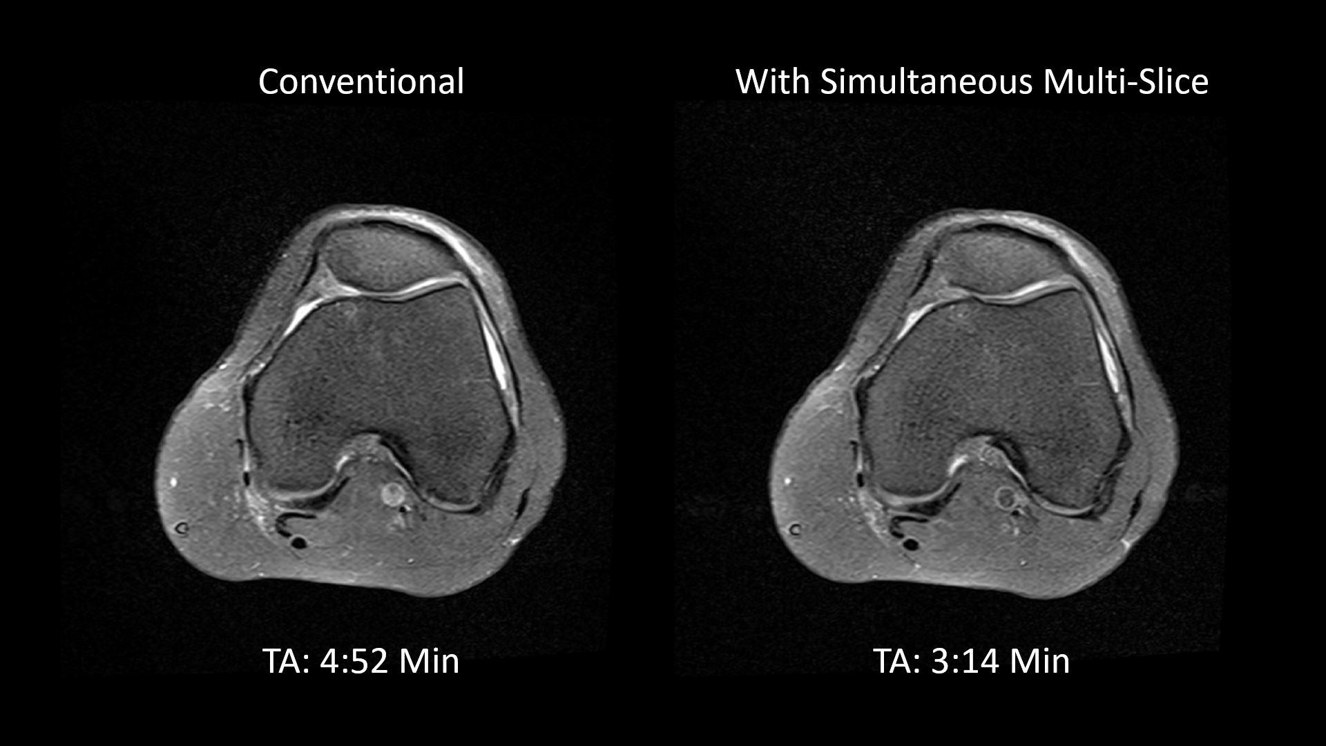 MAGNETOM Free.Max– Open Bore MRI