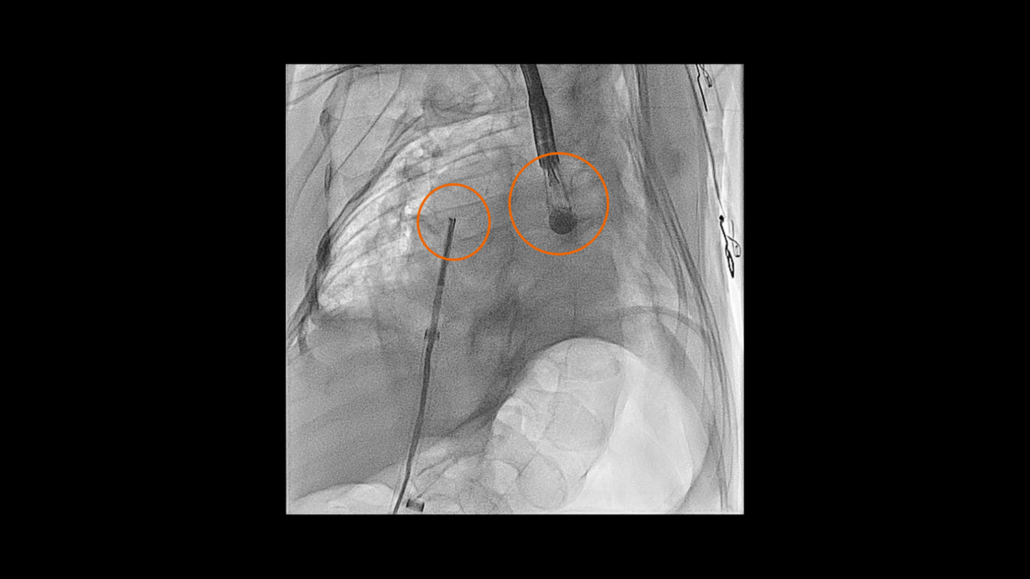 MitraClip Case Study