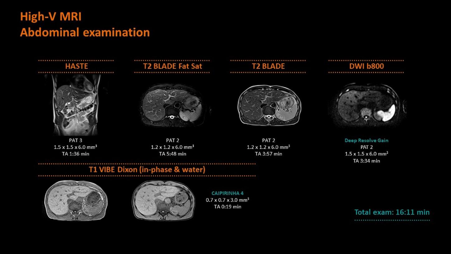 MAGNETOM Free.Max–wide bore mri