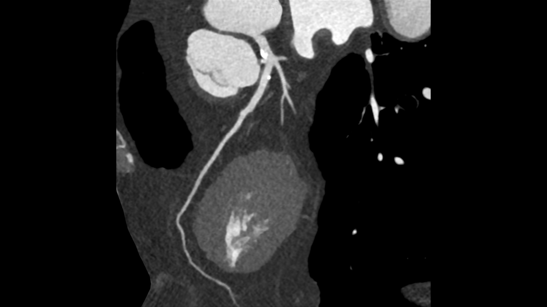 NAEOTOM Alpha photon-counting CT scanner