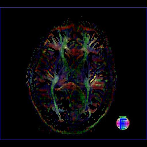 DTI Tractography