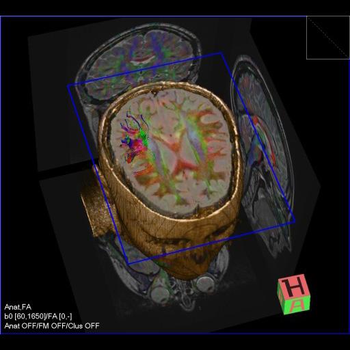 DTI Tractography