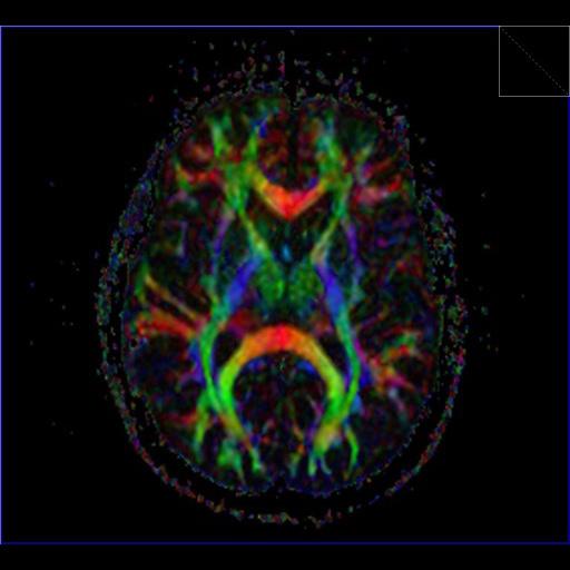 DTI Tractography