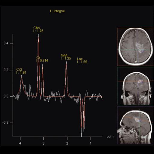 Chemical Shift Imaging (CSI)