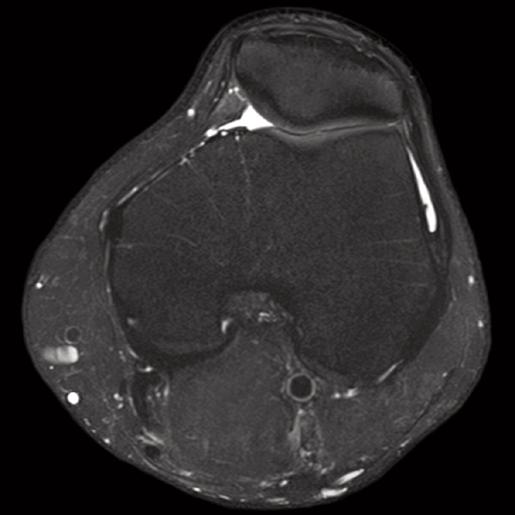 14-Channel Extremity Coil (MAGNETOM ESSENZA)