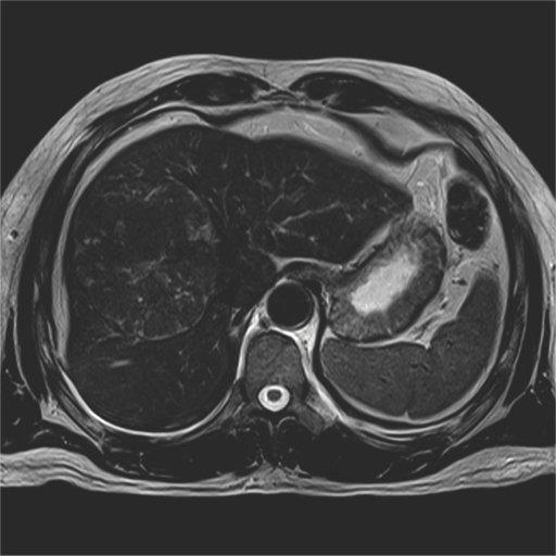 32-Channel Body Coil