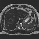 32-Channel Body Coil