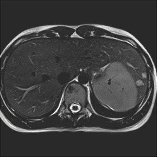 32-Channel Body Coil