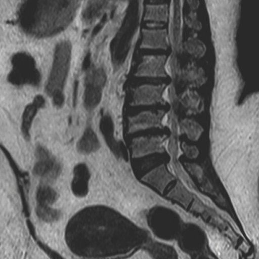 Body Spine Array Coil, XXL
