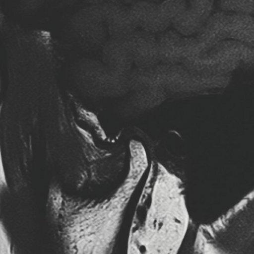 Double Loop Array Coil