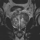 Endorectal Coil Interface