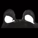 Sentinelle Breast Coil for MAGNETOM ESSENZA