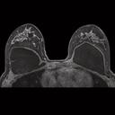 Sentinelle Breast Coil for MAGNETOM ESSENZA
