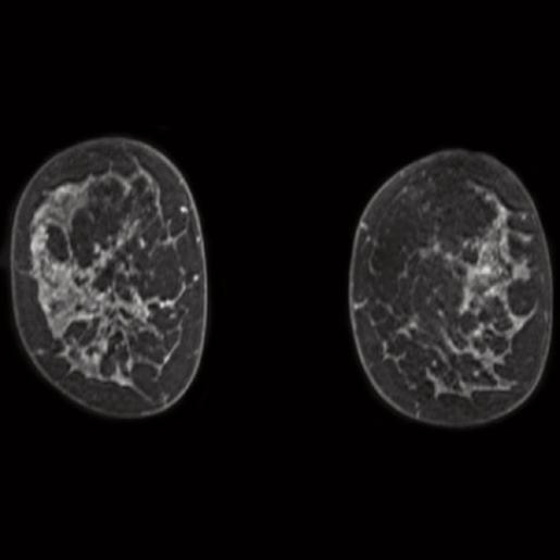 Sentinelle Breast Coil for MAGNETOM ESSENZA