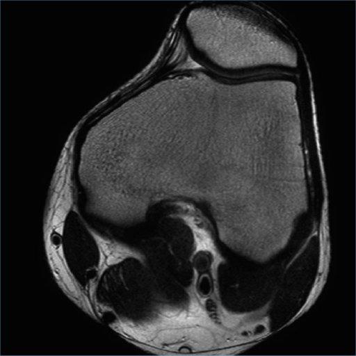 Tx/Rx 15-Channel Knee Coil