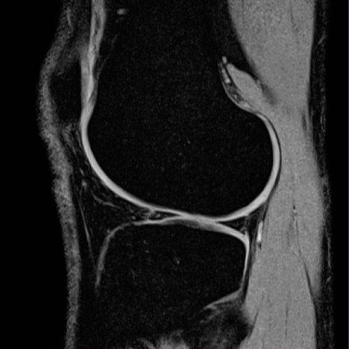 Tx/Rx CP Extremity Coil