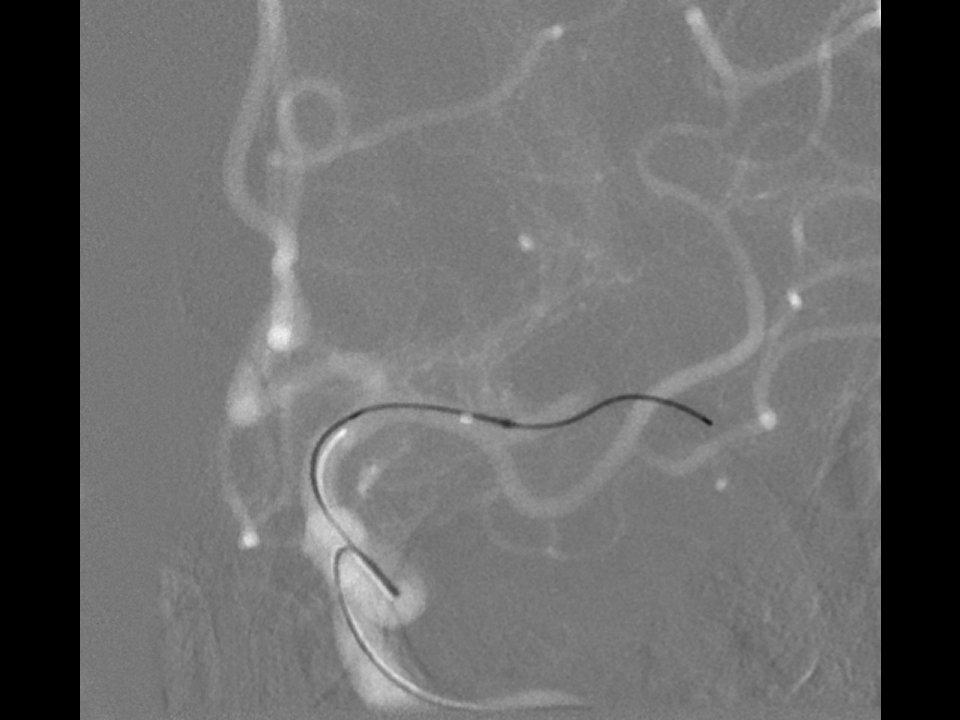 Artis zee biplane system eco for Interventional Radiology