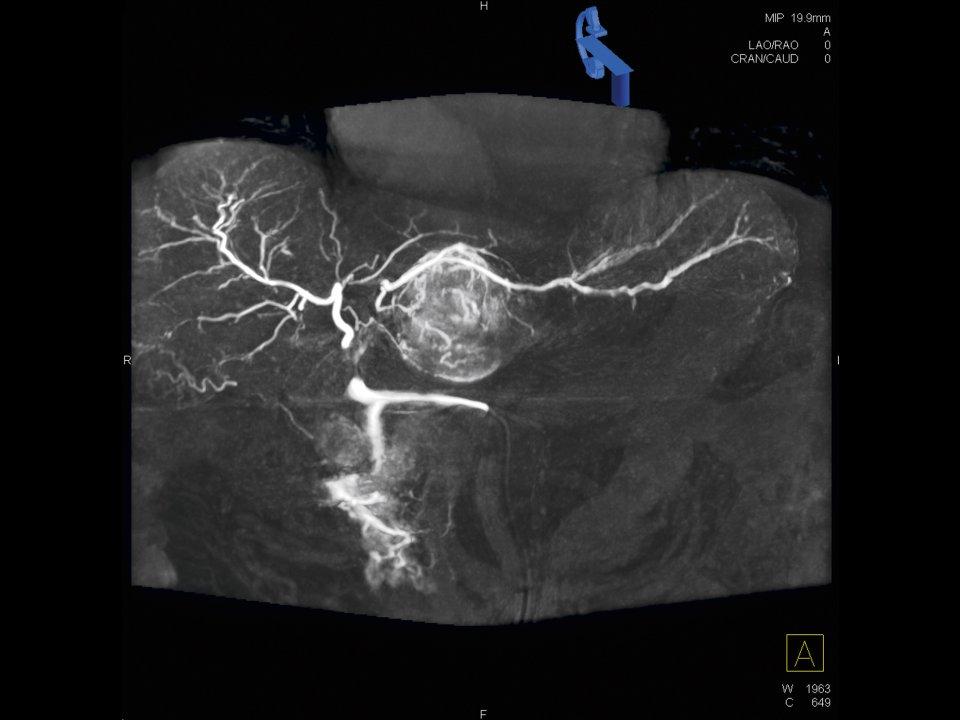 Artis zee biplane system eco for Interventional Radiology