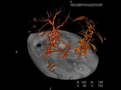 Artis zee biplane system eco for Interventional Radiology