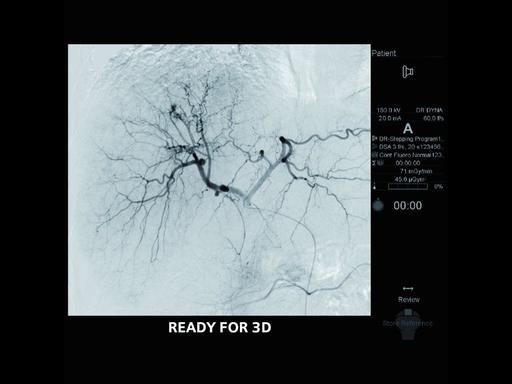 Artis zee biplane system eco for Interventional Radiology