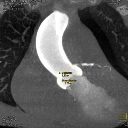 Artis zee biplane system eco for Interventional Radiology