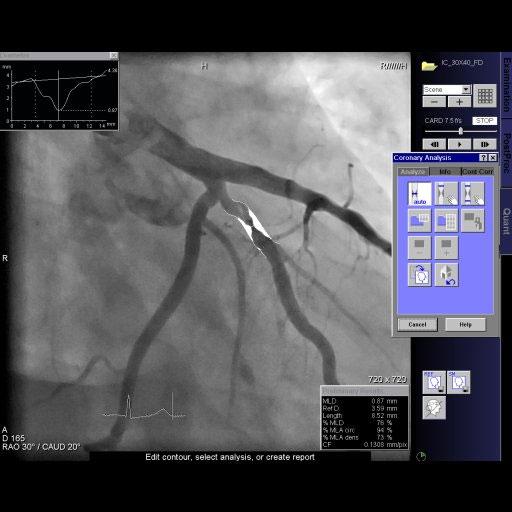 Artis zee biplane system eco for Interventional Radiology