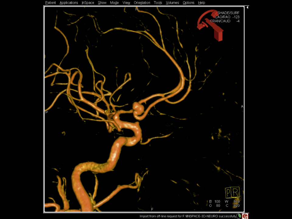 Artis zee biplane system eco for Interventional Radiology