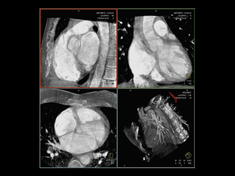 Artis zee biplane system eco for Interventional Radiology
