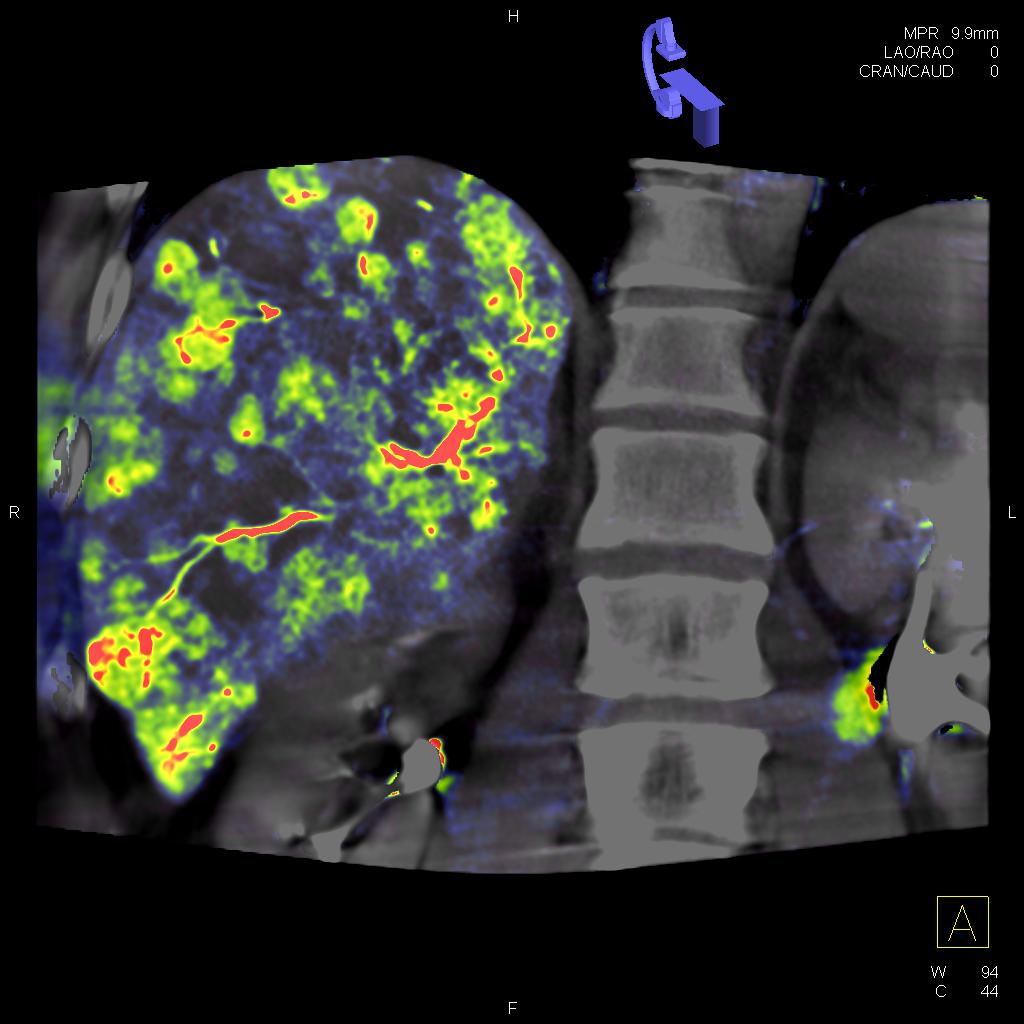 Interventional Oncology
