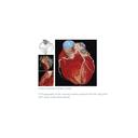 Approaches to Dose Reduction in Computed Tomography