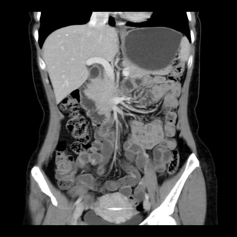 CT Scanner SOMATOM Scope
