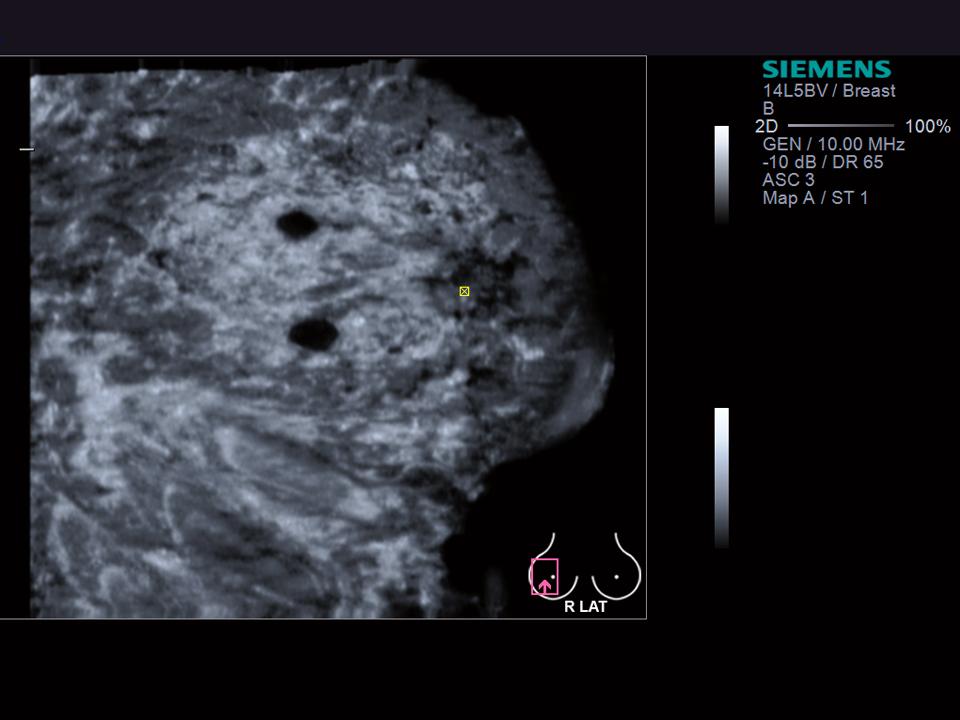 Breast imaging with ultrasound and mammography.