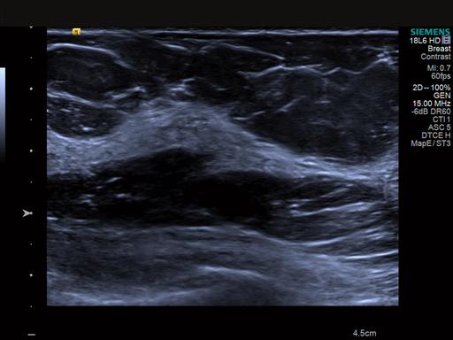 Breast imaging with ultrasound and mammography.