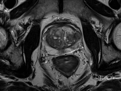 Prostate MRI