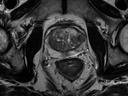 Prostate MRI