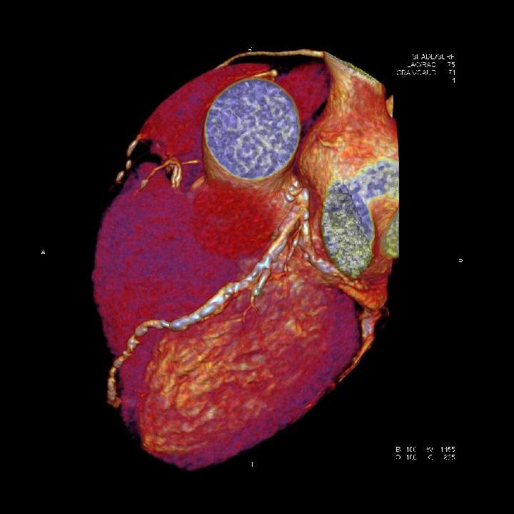 SOMATOM Definition Flash - CT Scanner