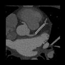 SOMATOM Definition Flash - CT Scanner
