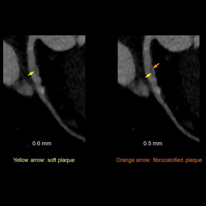 SOMATOM Definition Edge
