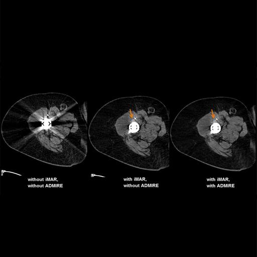 SOMATOM Definition Edge