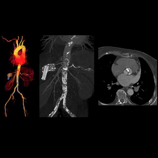SOMATOM Definition Edge