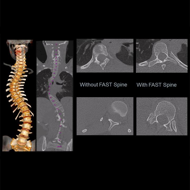 SOMATOM Definition Edge