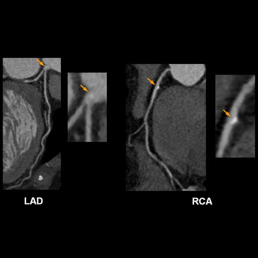 SOMATOM Definition Edge