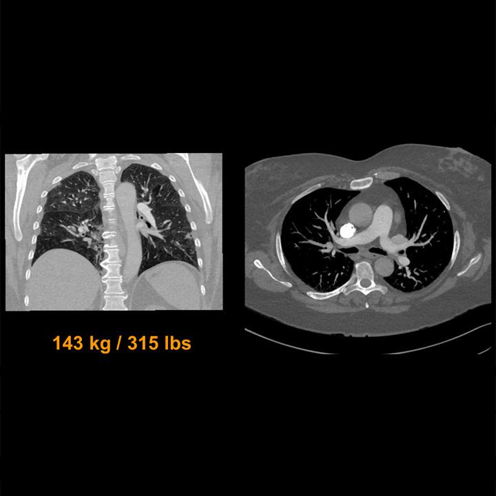 SOMATOM Definition Edge