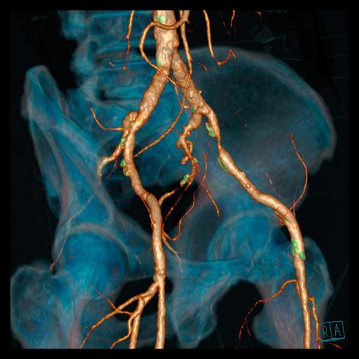 CT Scanner SOMATOM Scope