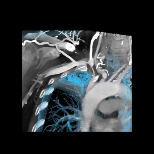 CT Scanner SOMATOM Scope