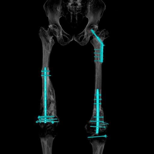 CT Scanner SOMATOM Scope